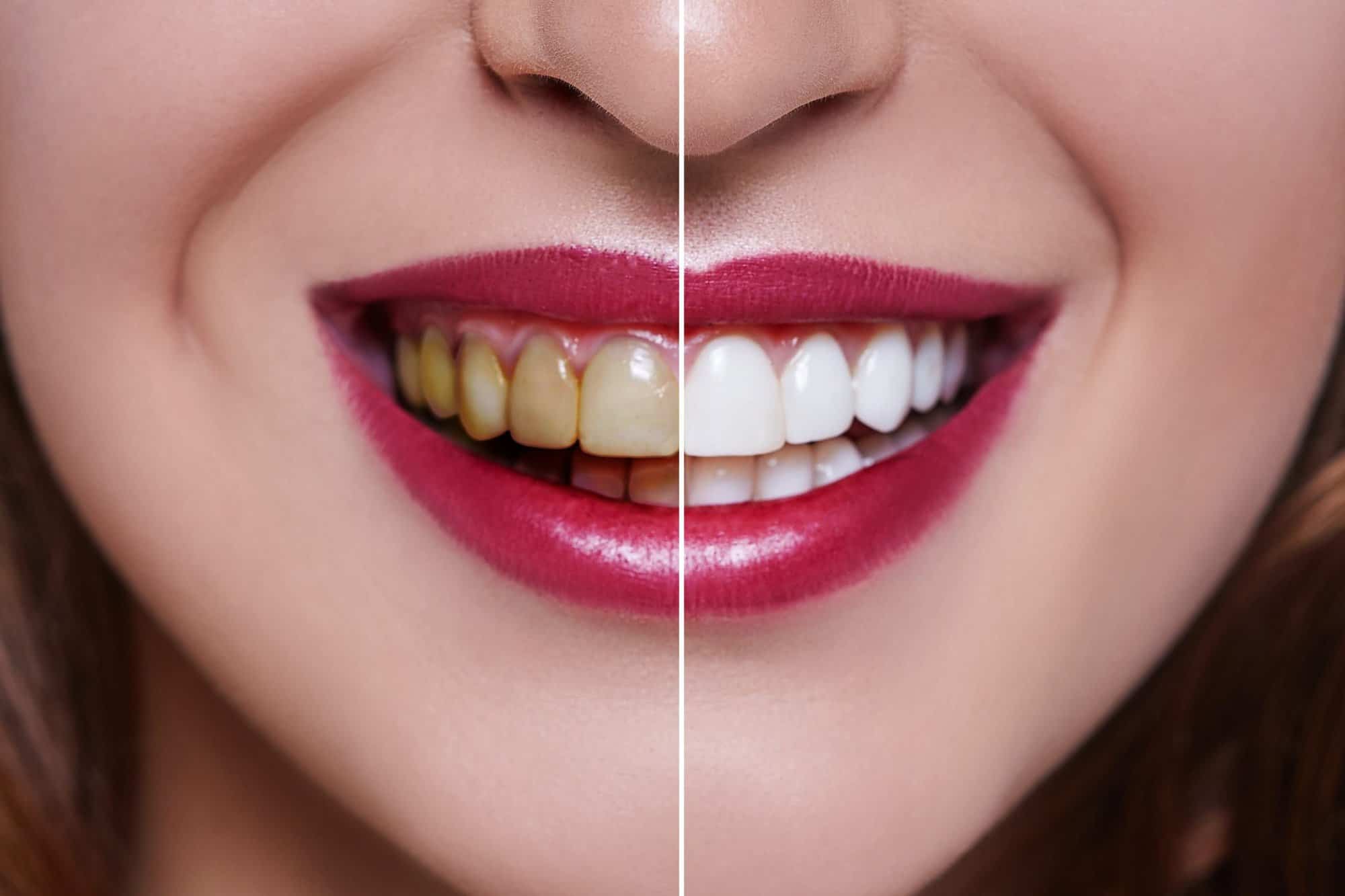 Teeth Whitening Care Dental Pandan Indah Ampang